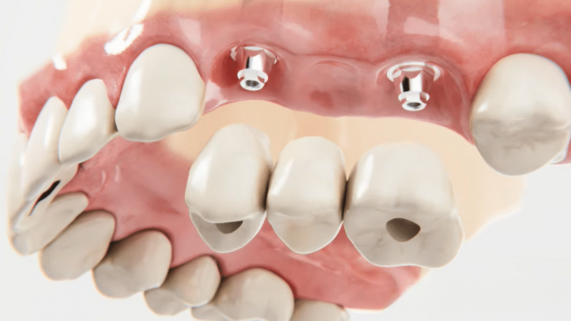 Implant Prosthetics / July 10-11, 2026 - White Cap Institute