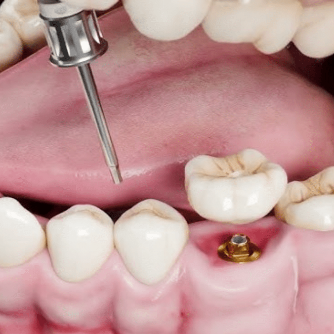 Implant Prosthetics - White Cap Institute